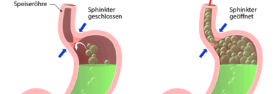 Reflux Behandlung/Operation - Dr. Sperker Chirurgie, 1030 Wien